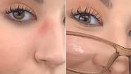 V zlat Citrom Menta Brown Spots On Nose From Glasses llatkert jjel V zlat Citrom Menta Brown Spots On Nose From Glasses llatkert jjel