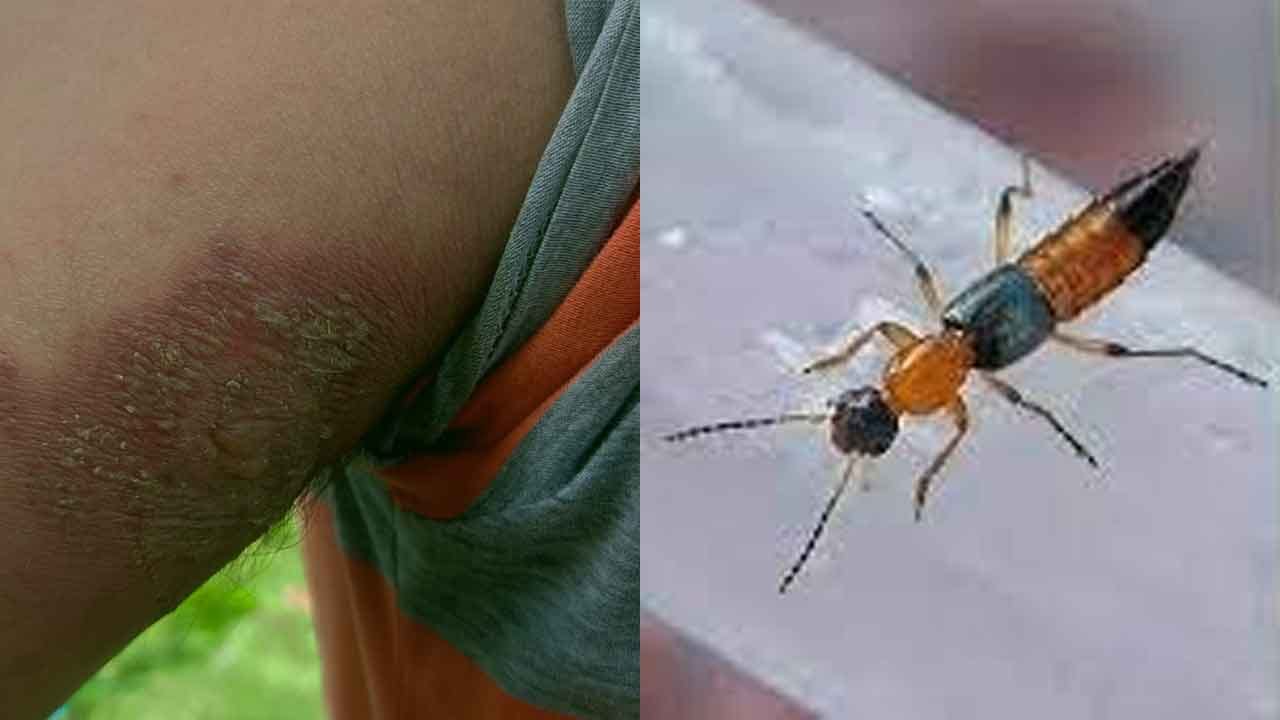 Jalpaiguri Nairobi Fly: ফস্কা পড়ে ঝলসে গিয়েছে চামড়া, জলপাইগুড়িতে ...