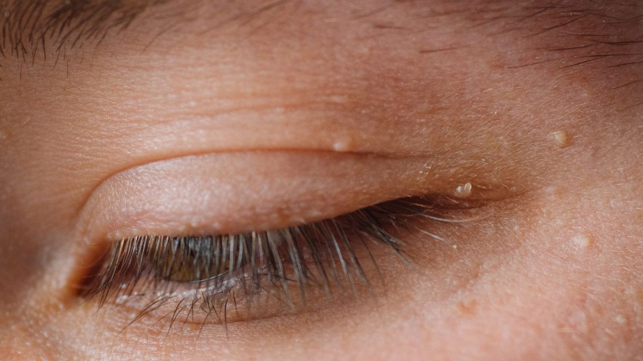 Cure of Milia: নাকে, থুতনিতে সাদা রঙের কুৎসিত 'মিলিয়া'! দ্রুত মুক্তি পেতে এই ঘরোয়া টোটকাই সেরা ...