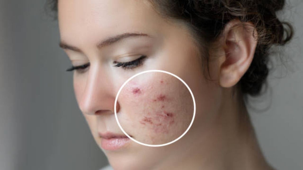 Pimples: বিয়ের আগেই মুখে ব্রণ? চিন্তা নেই এই সহজ টোটকাতেই হবে সমাধান ...