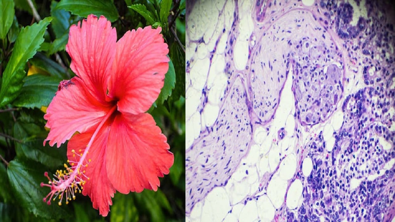 Hibiscus for Cancer Treatment: ক্যানসারের চিকিৎসার জন্য কার্যকরী ঘরোয়া ...