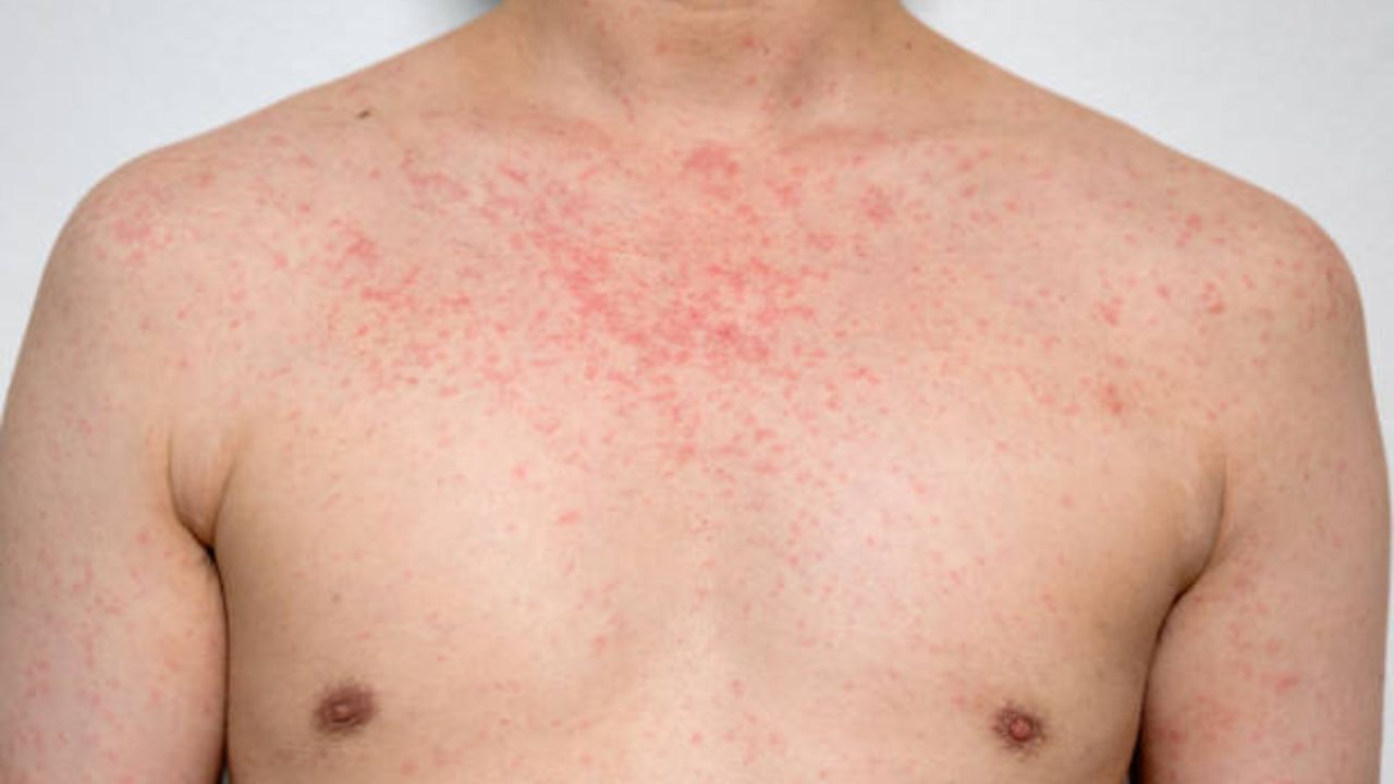 Prickly Heat Remedies গরম বাড়তেই পিঠভর্তি ঘামাচি দিনের দুবার এই কাজ করলেই মিলবে শান্তি