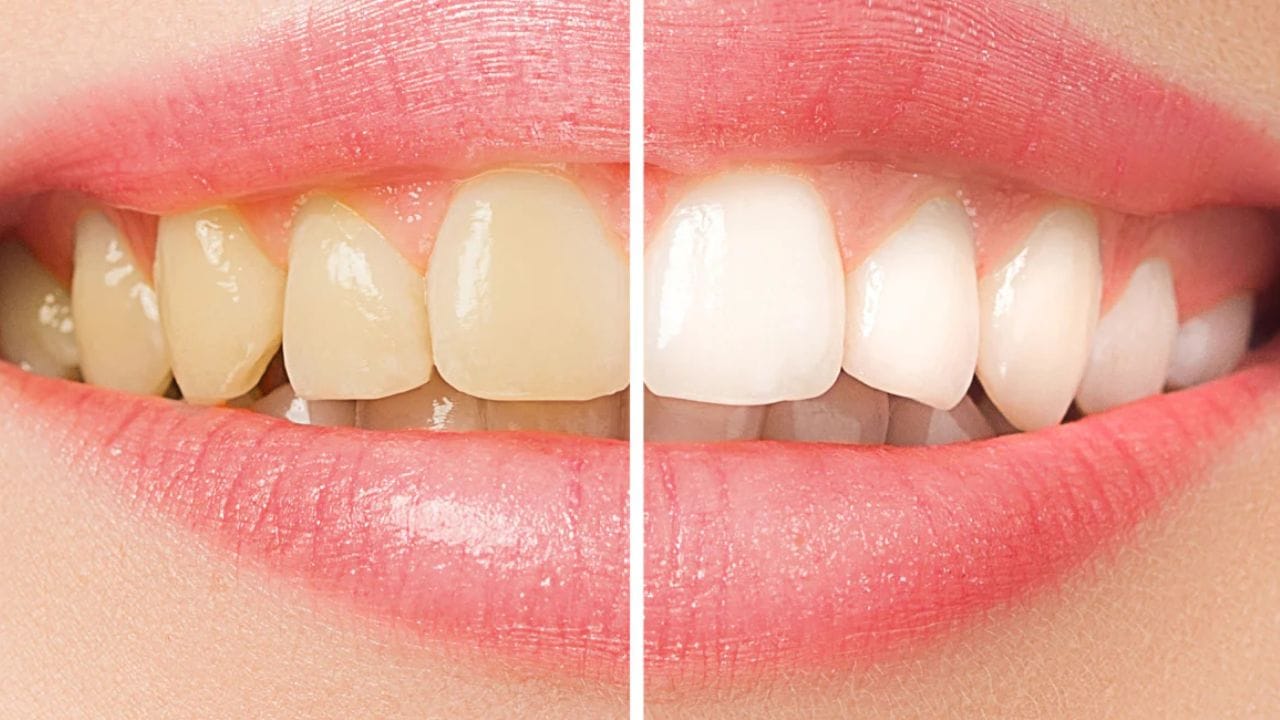 Yellow Teeth Care: দাঁতে হলুদ ছোপ? চিন্তা নেই, ঘরোয়া উপায়ে পান ...