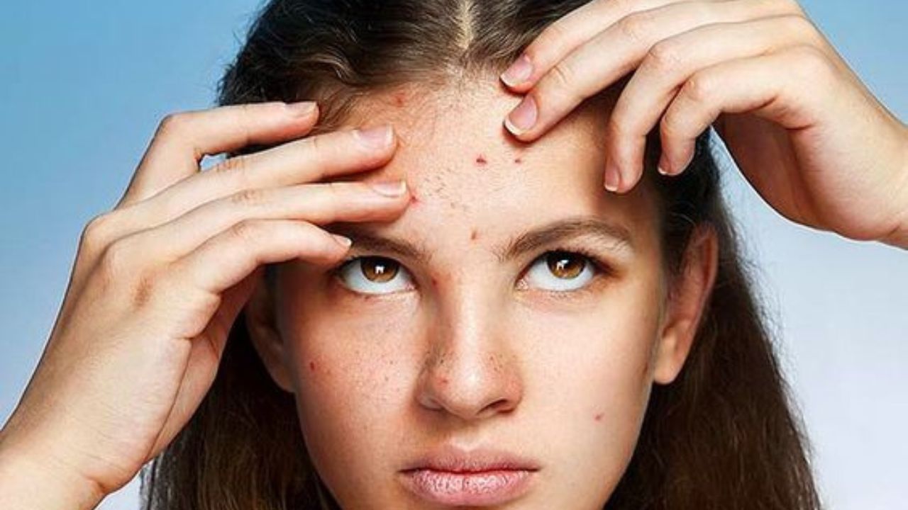 Forhead Acne Care: কপাল ভর্তি ব্রণ? সমস্যার সমাধান লুকিয়ে হাতের কাছেই ...